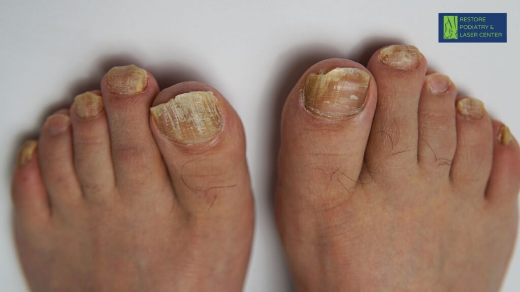 Yellow, Thick, or Crumbling? Signs Might Have Toenail Fungus