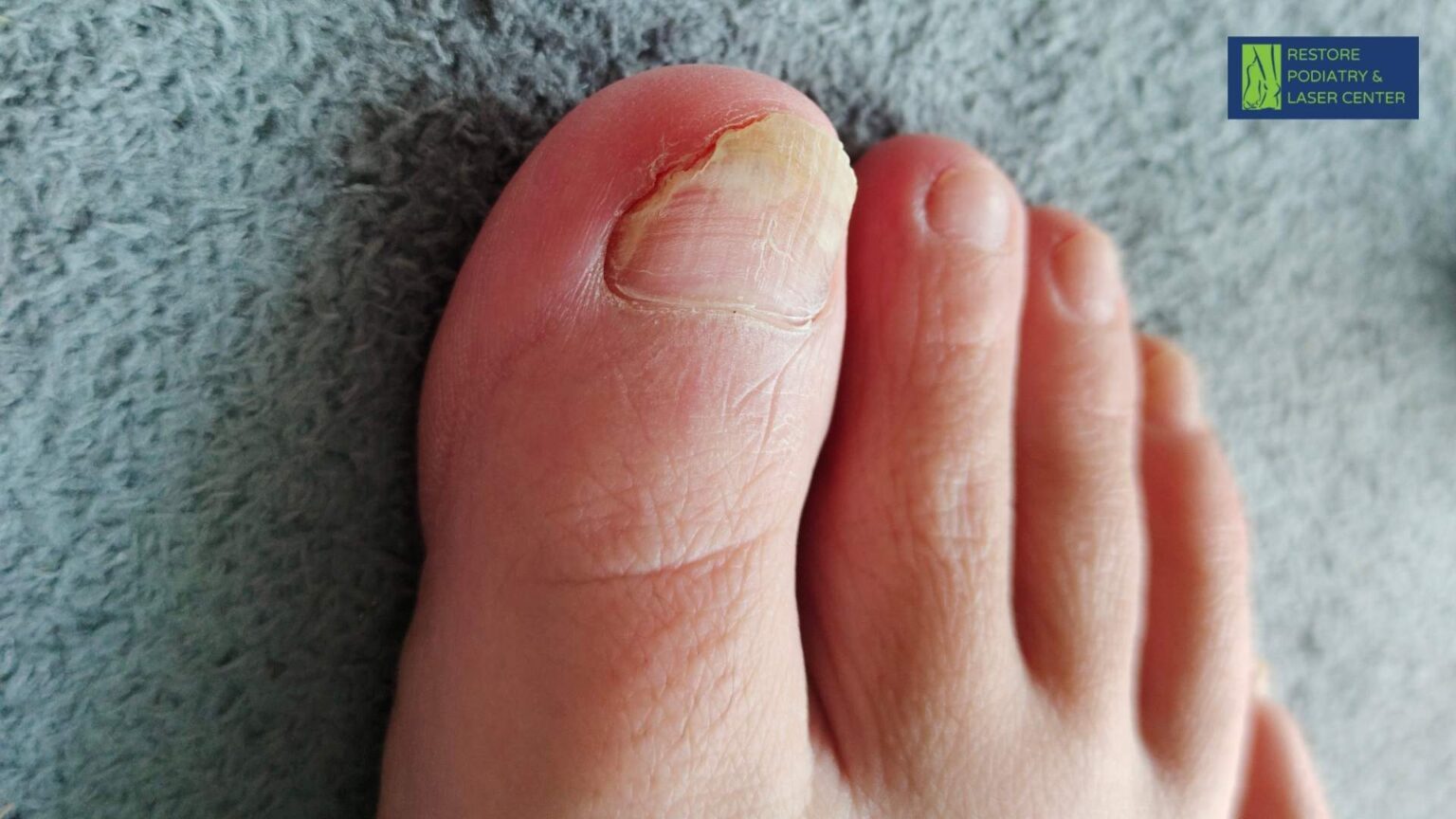 Yellow, Thick, or Crumbling? Signs Might Have Toenail Fungus