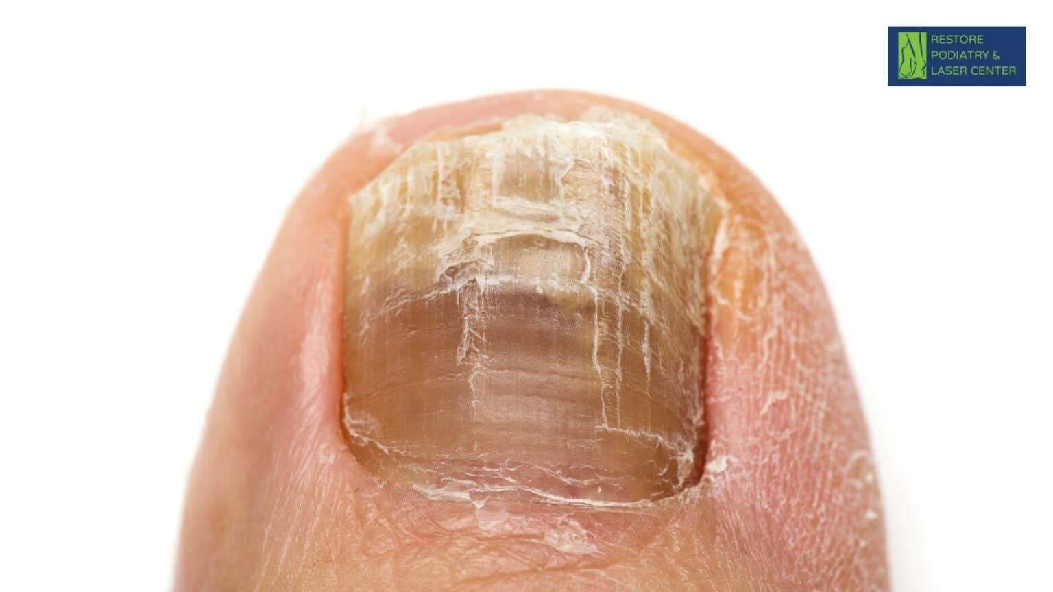 Yellow, Thick, or Crumbling? Signs Might Have Toenail Fungus