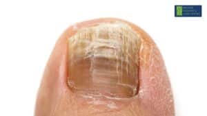 Yellow, Thick, or Crumbling? Signs Might Have Toenail Fungus