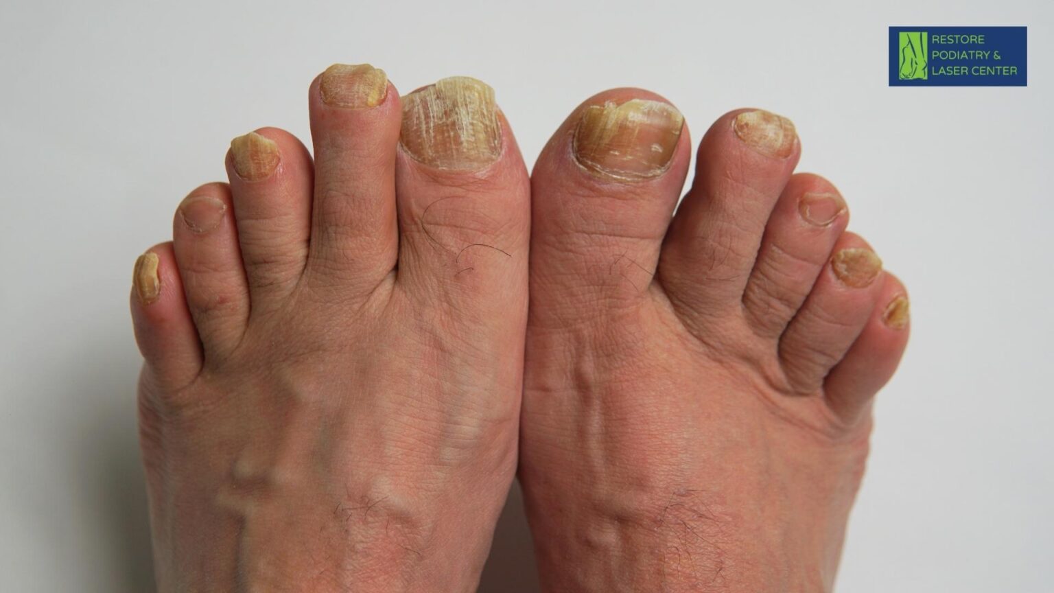 Toenail Fungus vs. Nail Damage: How to Spot the Difference